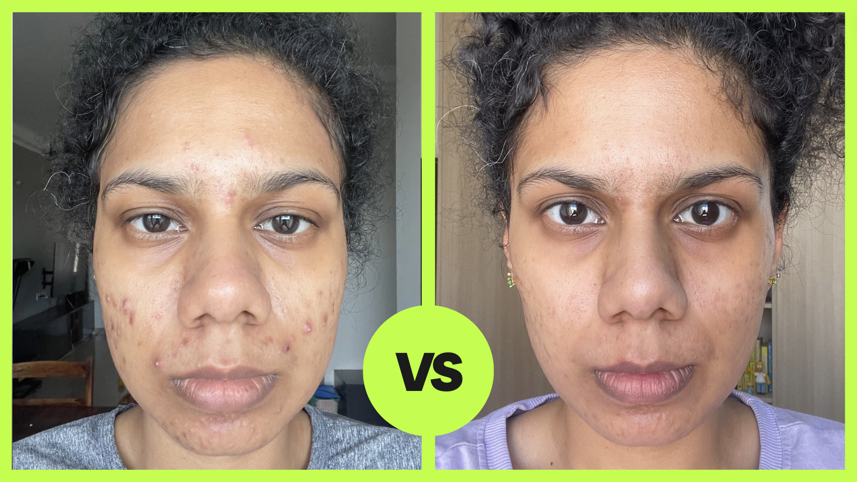 How I Got Rid of Acne Hyperpigmentation and Dark Spots in 10 Weeks(Dark ...