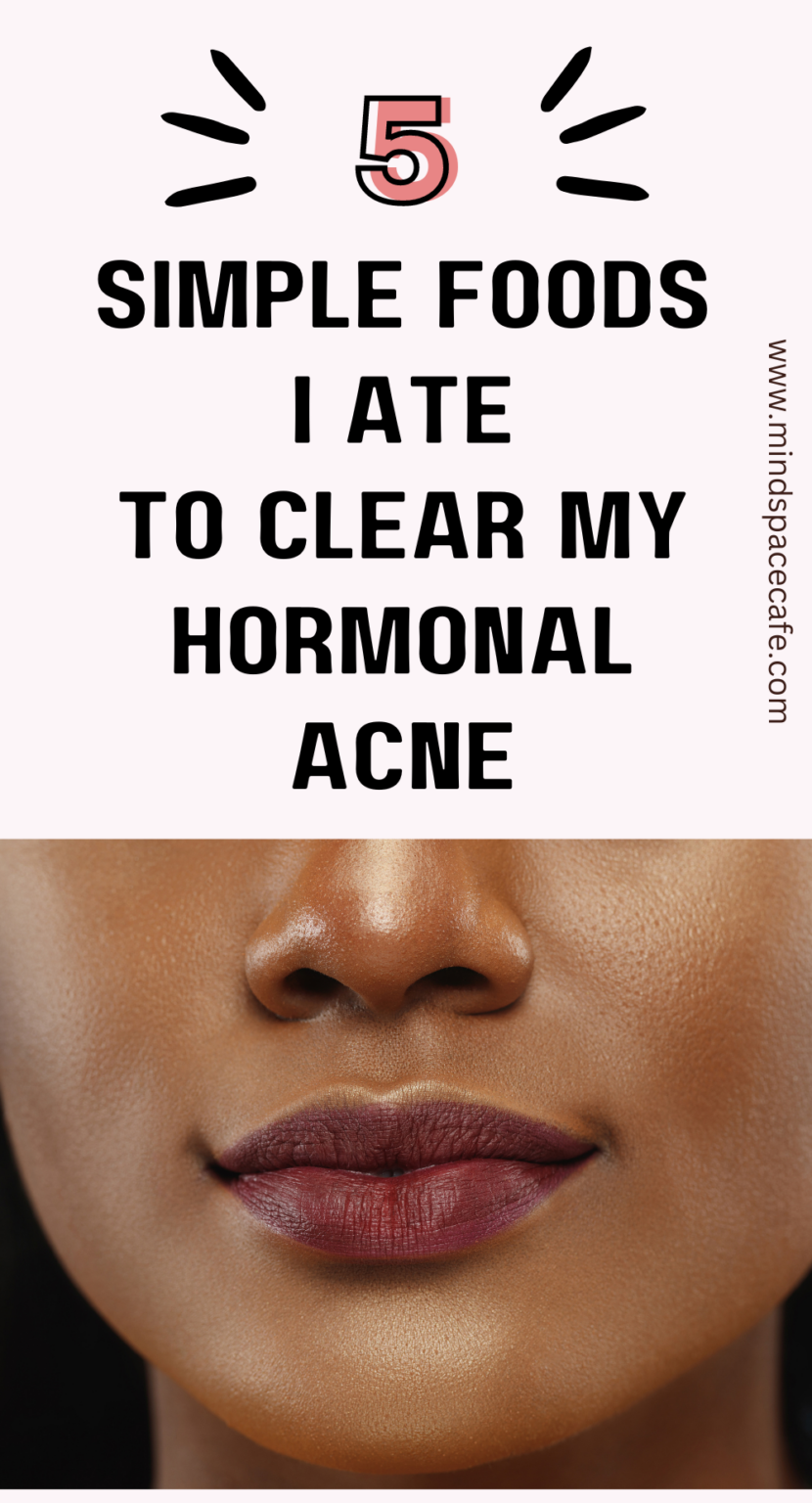5 Foods that Cleared my Hormonal Cystic Acne for Good (Hormonal Acne ...