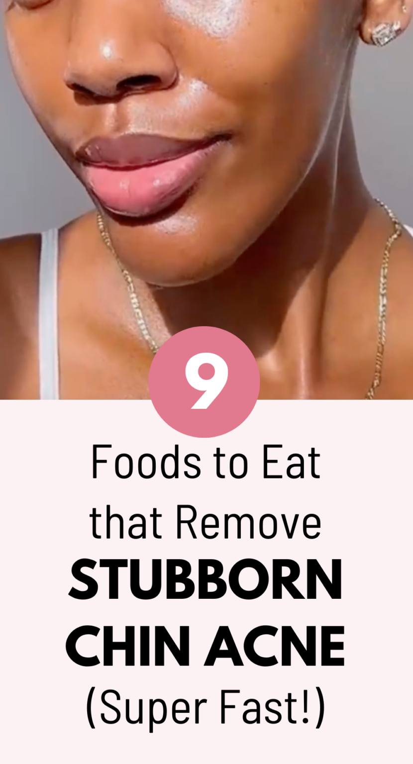 9 Foods that Cleared My Stubborn Chin Acne for Good (Hormonal Acne Diet ...