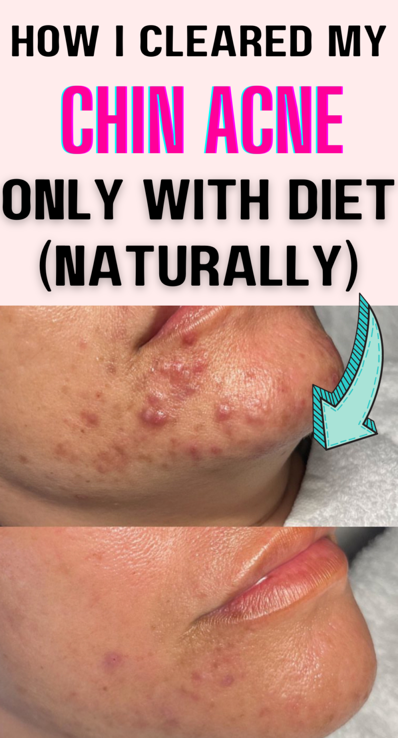 9 Foods that Cleared My Stubborn Chin Acne for Good (Hormonal Acne Diet ...
