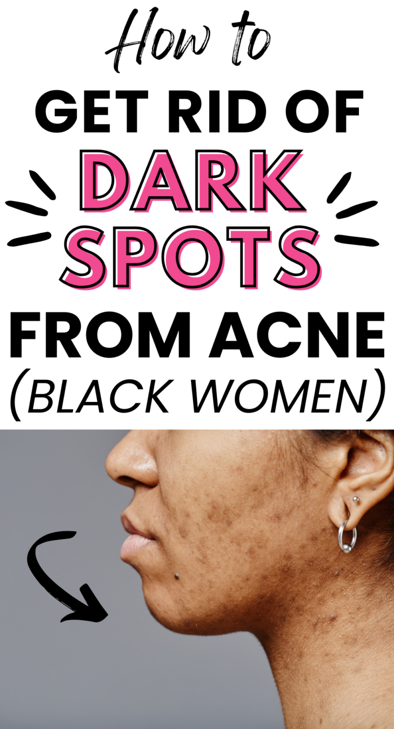 How I Got Rid of Acne Hyperpigmentation and Dark Spots in 10 Weeks(Dark ...