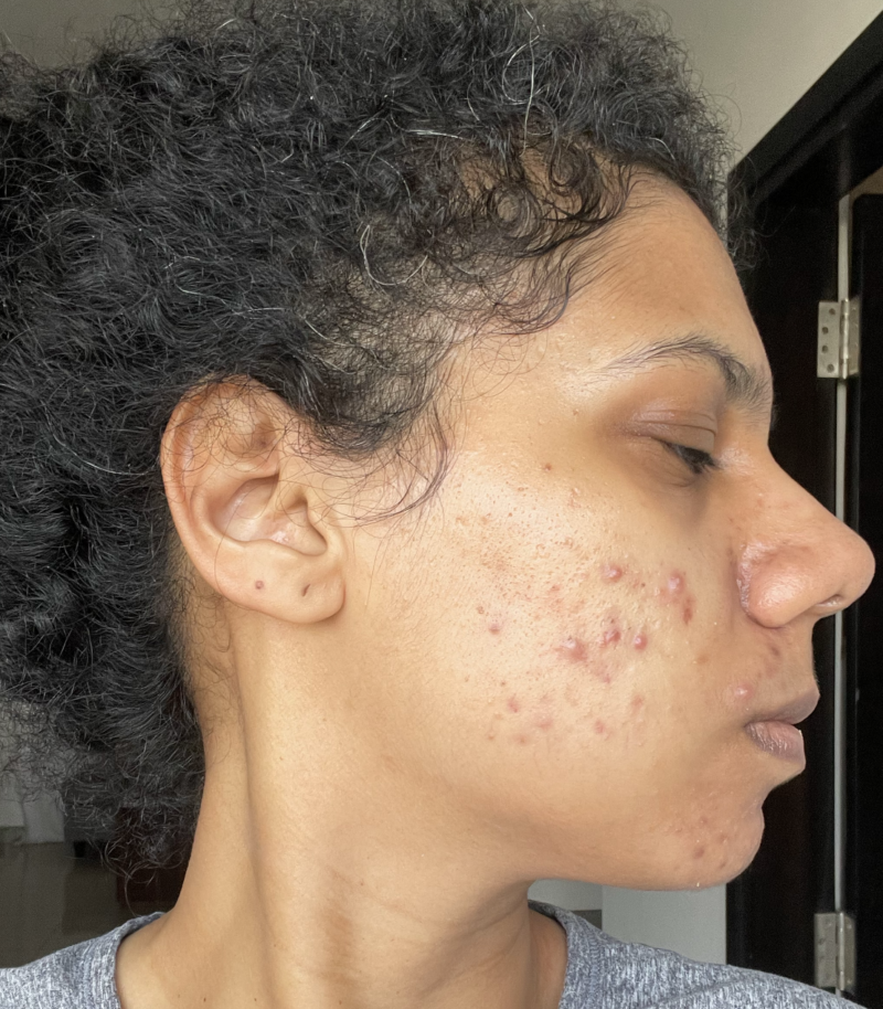 How I Got Rid of Acne Hyperpigmentation and Dark Spots in 10 Weeks(Dark ...